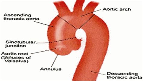 Bentall Surgery Advance Cardiac Hospitals In India