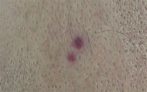 점빼고 3주차 됬는데 얼굴에 검은색 점이 지식in