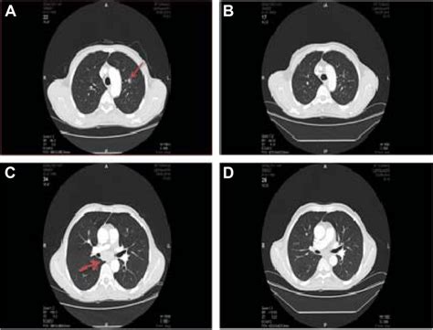 Patients Chest Computed Tomography Ct Notes A And C Before