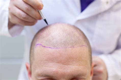 Greffe De Cheveux Techniques Fue Et Fut Pour Lutter Contre La Calvitie