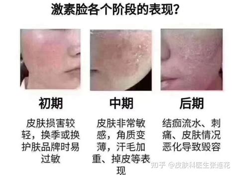 【赣州肤斗士皮肤科】激素脸、脂溢性皮炎、玫瑰痤疮如何区分？ 知乎