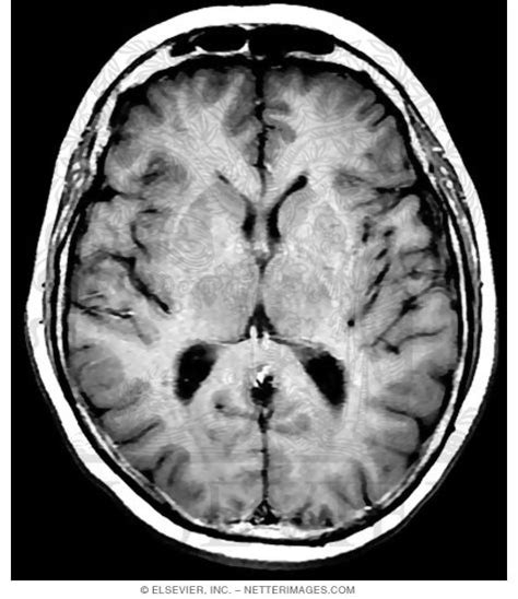 T1 Weighted MRI Before Contrast