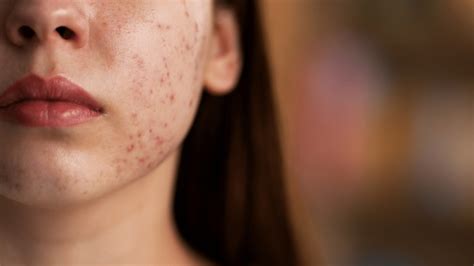 বাৰে বাৰে মুখত শালমইনা ওলাই নেকি তেন্তে খাওক এইসমূহ খাদ্য দূৰ হব