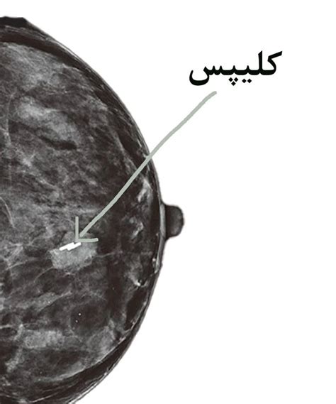 مارکرگذاری در توده های پستانکلینیک تصویربرداری صبا