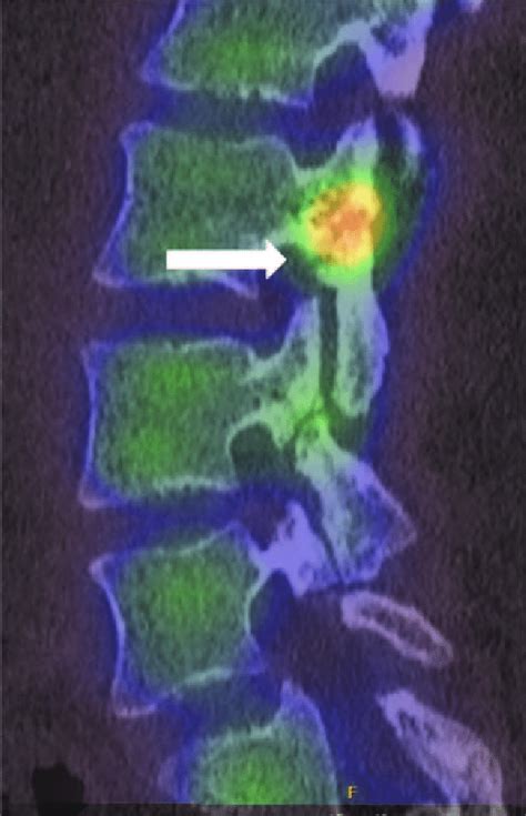 Sagittal Single Photon Emission Ct Reconstruction Showing More Acute L3