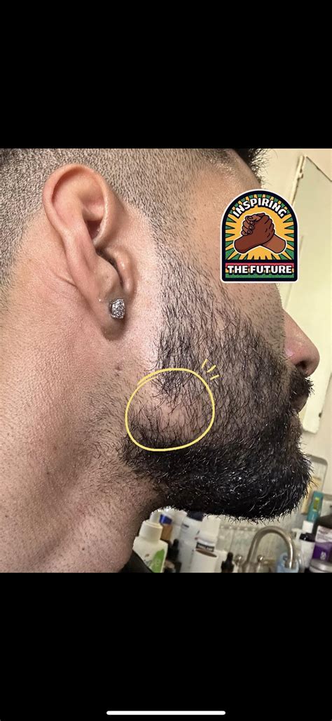 Random Beard Patch Appeared All Of A Sudden I Used To Have A Full