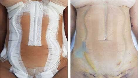 SciELO Brasil Lipoaspiração abdominal evoluindo de alta para média