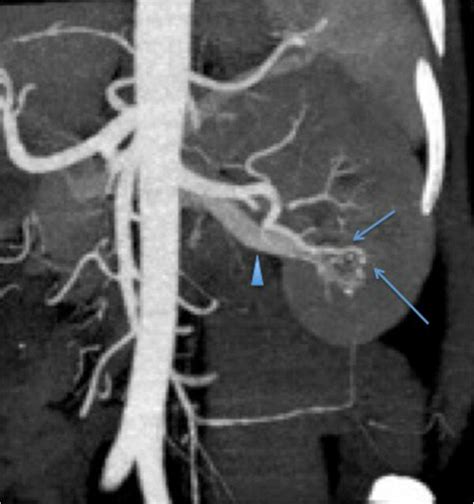 Sagittal Oblique Multiplanar Reformat Image Of The Computed Tomography Download Scientific