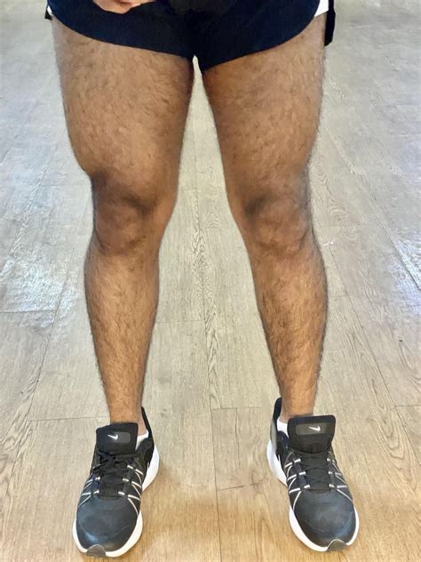 21m 13 Weeks Post Op Acl Meniscus Does My Right Leg Quad Look Any