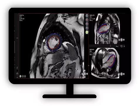 Philips Mr Caas Strain Quantify Myocardial Strain
