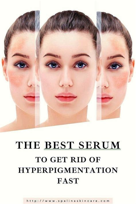 Best Hyperpigmentation Serum To Get Rid Of Hyperpigmentation Fast
