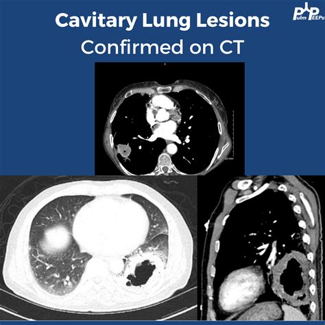 Pulmpeeps Pulmonary And Critical Care Content For Learners And Practitioners Of All Levels