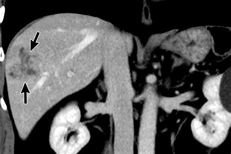 Expected And Unexpected Imaging Findings After 90y Transarterial