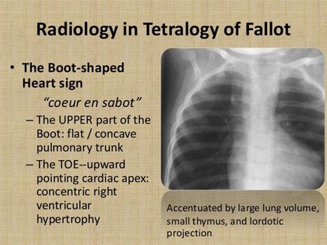 The Boot Shaped Heart Sign