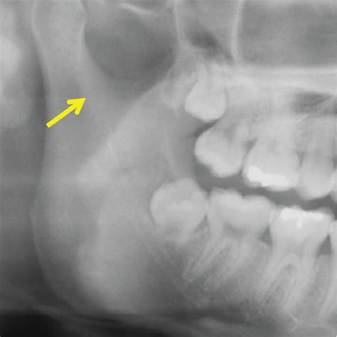 The Histopathology Of The Peripheral Osteoma A Microscopic Features