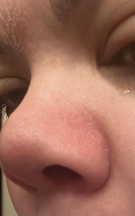 Skin Issue Very Dry Skin Scaley Eczema Psoriasis Or Other R