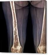 Bone Disease Photograph By Zephyr Science Photo Library Fine Art America