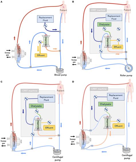 Combining Ecmo And Crrt Physiology For Perfusionist