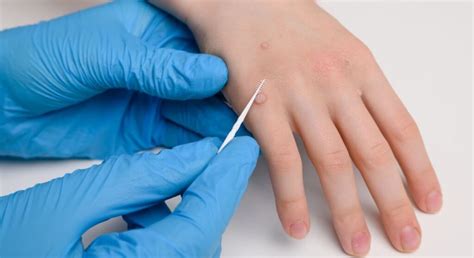 Tipuri De Veruci și Imagini Pentru A Le Recunoaște Mai Ușor Dr Leventer Centre