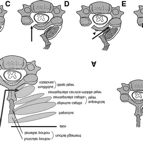 Schematic Drawing Illustrating The Operative Approach Of Unilateral