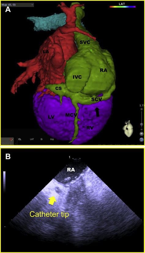 Cavotricuspid Isthmus Ablation For Atrial Flutter Anatomic Challenges