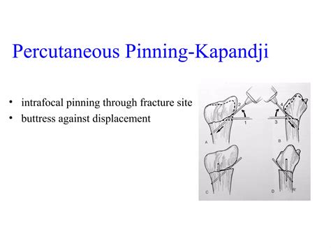 Distal Radius Fracture Ppt