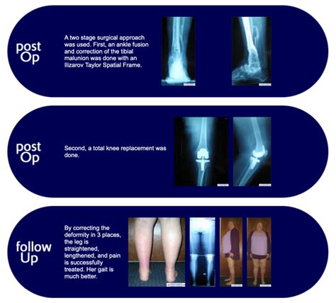 Correction Of Knock Knee Deformity Limb Lengthening