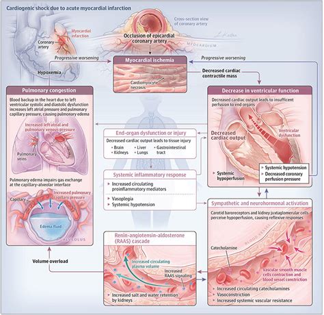 Acute Myocardial Infarction Pathophysiology