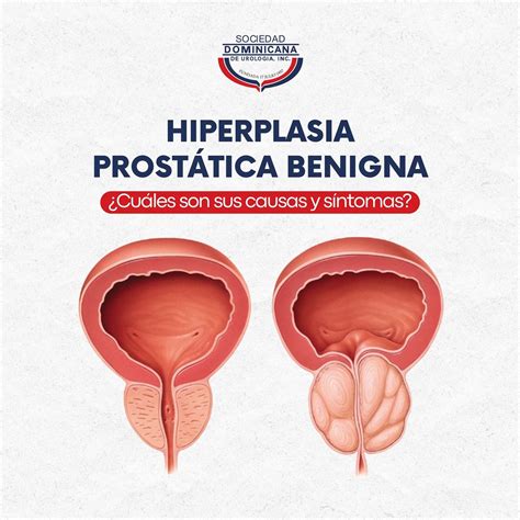 Hiperplasia Prostática Benigna Hpb Síntomas Causas Y Tratamientos