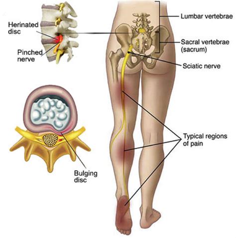 Sciatic Hernia Treatment