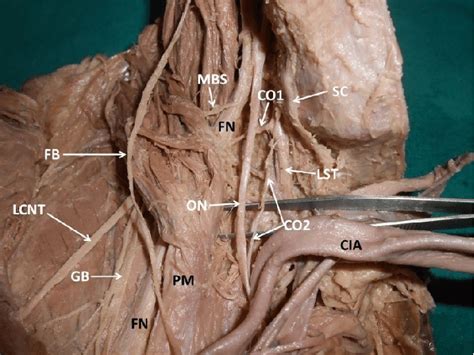 Dissection Of The Variant Branches Of Right Lumbar Plexus Caption Fb