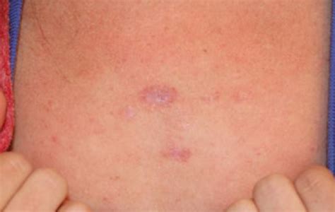 Krf Clinical Practice Guidelines In Keloid Disorder Treatment Strategy