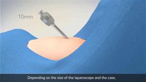 Abdominal entry In laparoscopic gynecologic surgery - YouTube