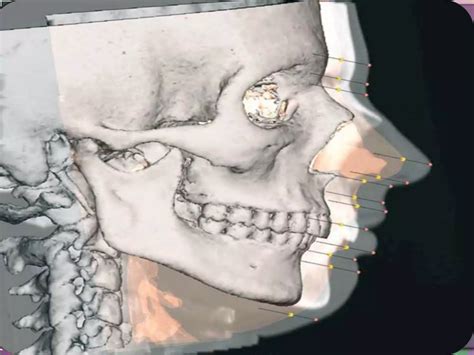 Lateral Cephalometric Analysis In Orthodontic Ppt