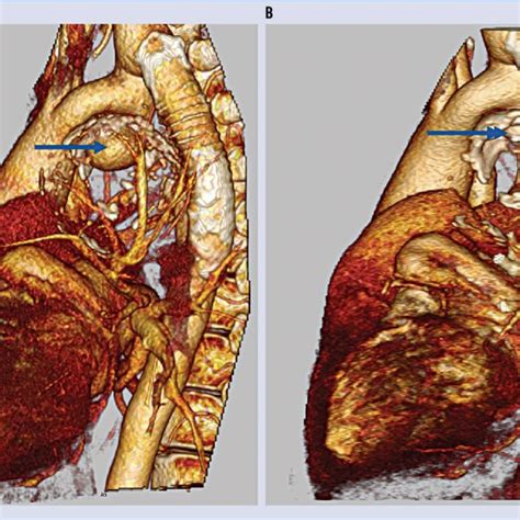 Computed Tomography Volume Rendering Reconstruction Showing The Anatomy Download Scientific