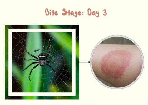 Southern Black Widow Spider Bite Stages Symptoms With Pictures