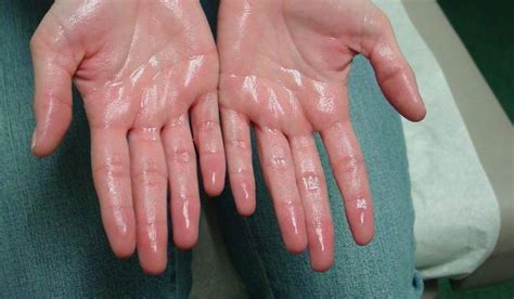 Hyperhidrosis Western Toronto Thoracic Associates