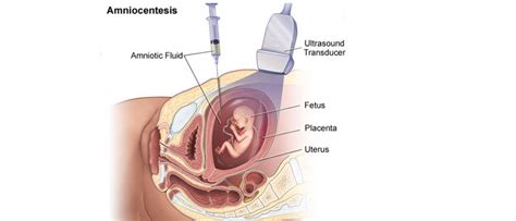 Amniocentesis Test During Pregnancy