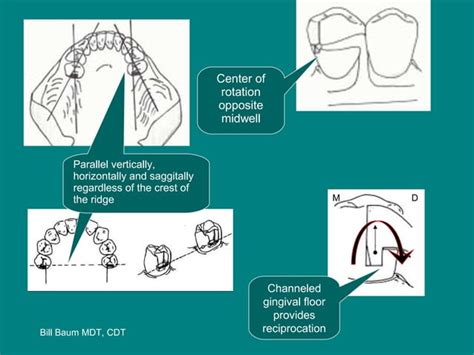 Removable Partial Denture Retainer Systems Ppt