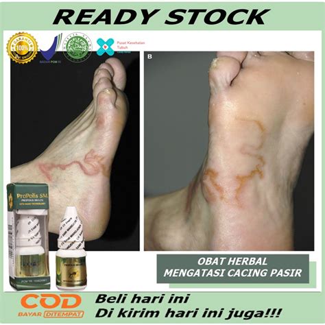 Jual Obat Oles Cacing Pasir Dewasa Obat Penghilang Cacing Pasir Obat