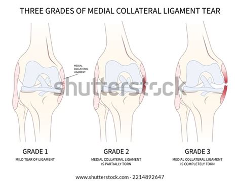 Classification Medial Collateral Ligament Injury Test Stock Vector