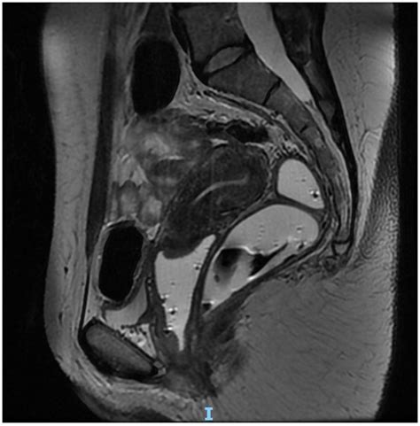 Diffuse Thickening Of The Junctional Zone Shown By Magnetic Resonance