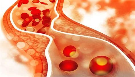 When Do You Start Screening For Hyperlipidemia