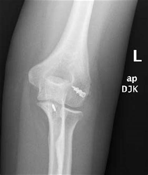 Evaluation And Management Of Complex Elbow Dislocations The Clinical
