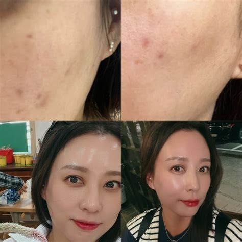 트레티노인 연고 사용법 스티바a크림 3년사용한 찐후기 네이버 블로그
