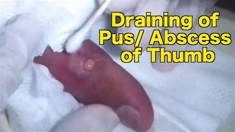 Drainage Of Thumb Abscess Using A Cotton Pledget Youtube