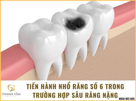 Nhổ Răng Sâu Số 6 Hàm Dưới Trong Trường Hợp Nào