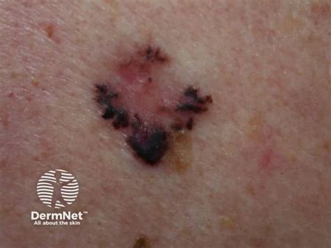 Basal Cell Carcinoma Affecting The Face Image