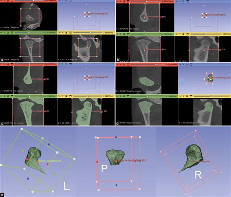 Three Dimensional Assessment Of Condylar Morphology Position And Joint Spaces In Different Jaw