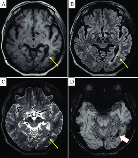 Magnetic Resonant Imaging Mri In Axial Projection Shows Area Of